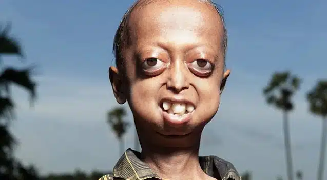Progeria Makes 14 Year Old Boy Look Like 110 Year Old Man
