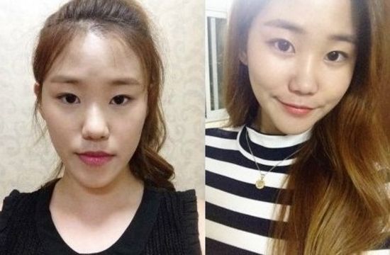Crazy Before And After Photos Of South Korean Plastic Surgery