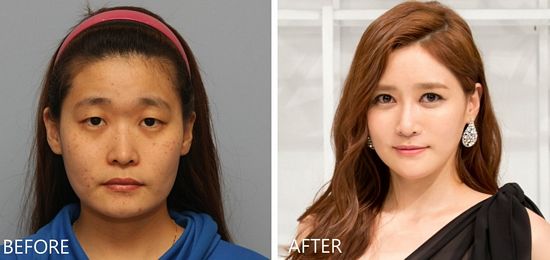 Crazy Before And After Photos Of South Korean Plastic Surgery
