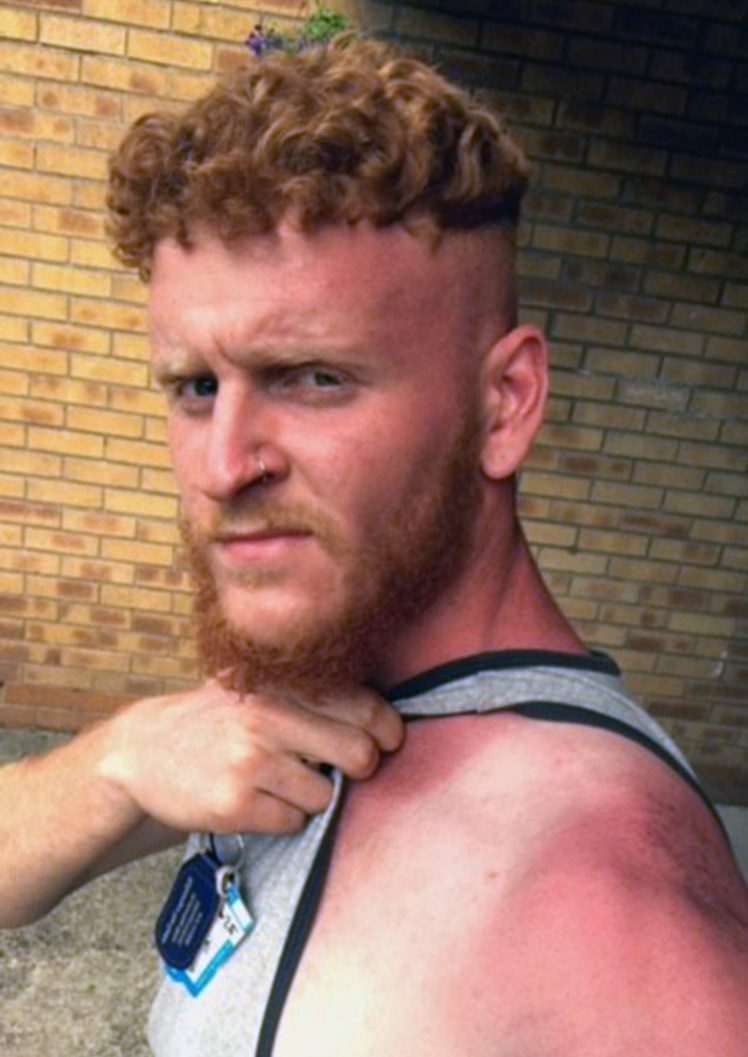 Ginger Dude Suffers Third Degree Burns After Spending Too Much Time In ...