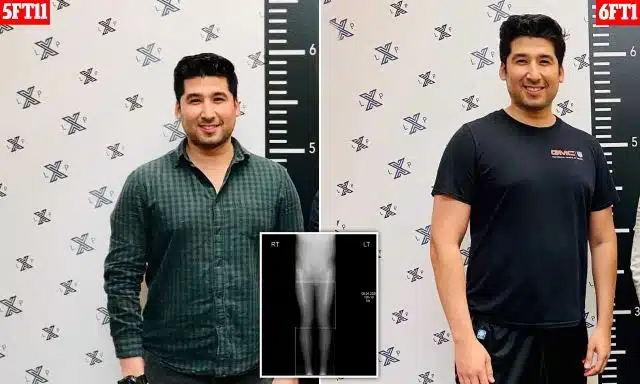 5'11 Man Undergoes Surgery To Lengthen His Limbs And Become 6'1